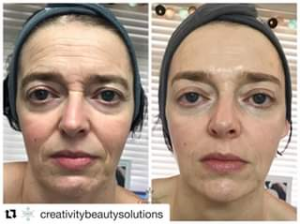 Bio-Therapeutic Microcurrent Technology - Acuity Massage and Advanced ...